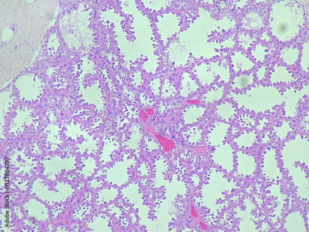 photomicrograph Histology of a breast biopsy from a pregnant woman ...