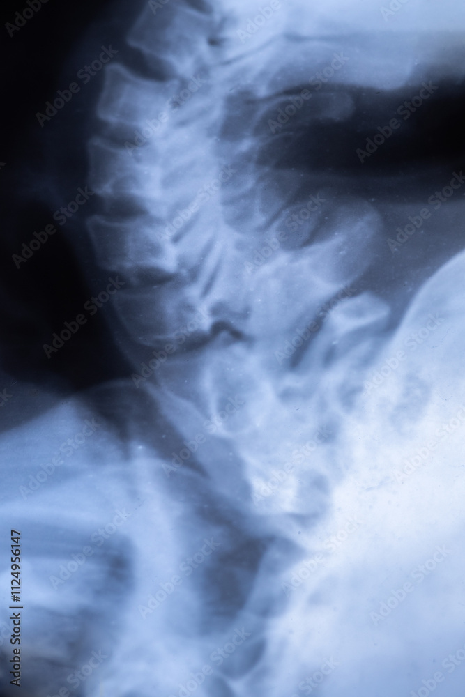 Vertical image of X-rays for Diagnosing Whiplash Injuries of Cervical ...