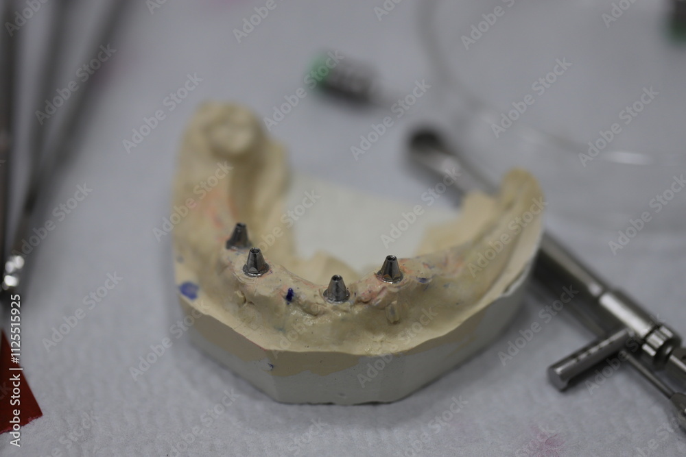 Full arch dental prosthesis treatment applied to edentulous jaws. The ...