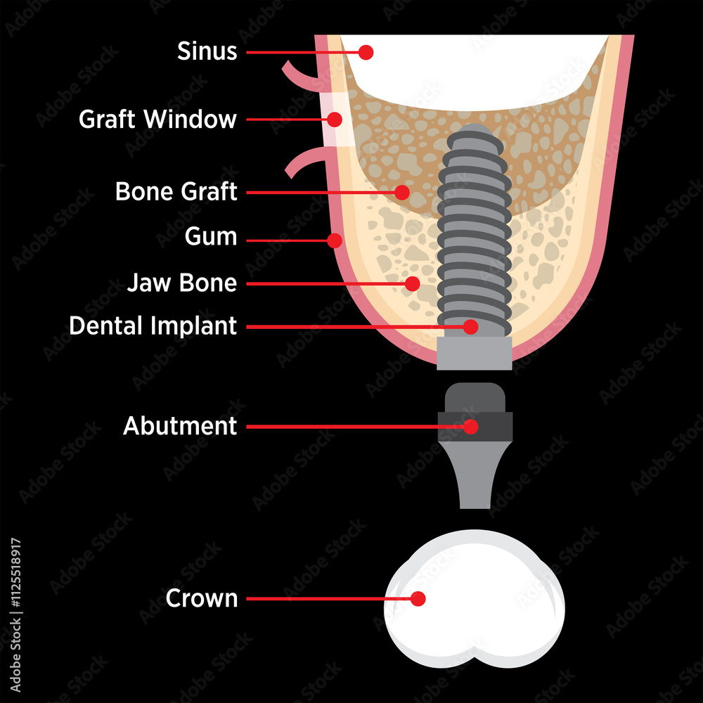 Dental implant treatment in dental dentistry and jaw surgery ...