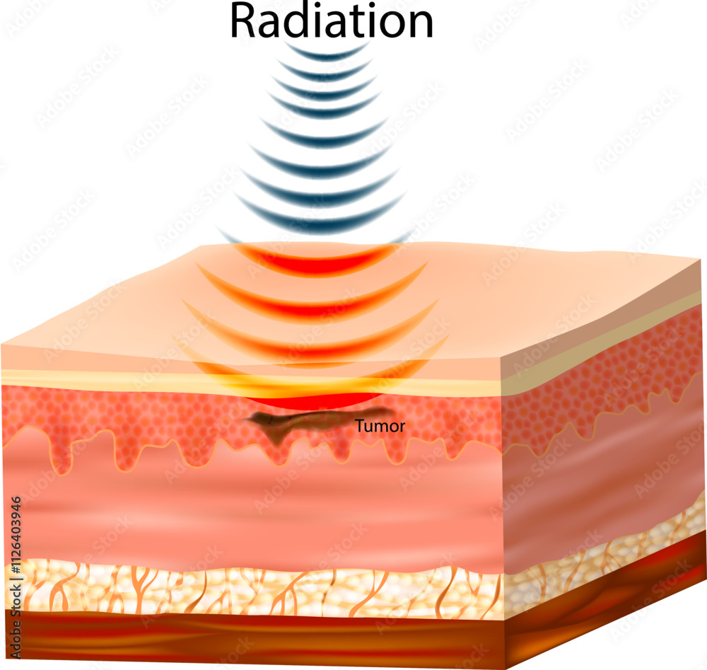 Radiation therapy or radiotherapy. Cancer treatment that uses high ...