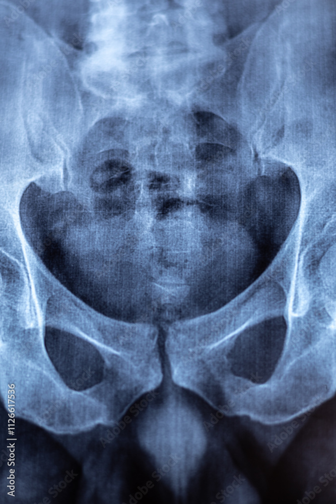 MRI of Bones of the Lumbar Spine and Pelvis. Pinched discs of spine and ...