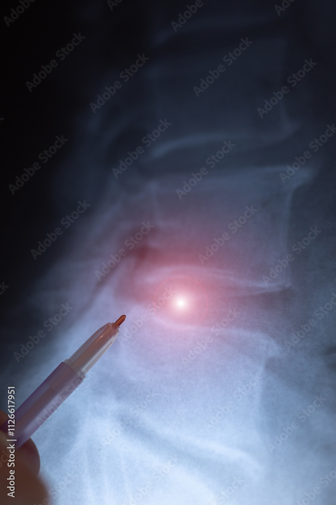 Doctor learn vertical X-ray scan of intervertebral discs in spine ...