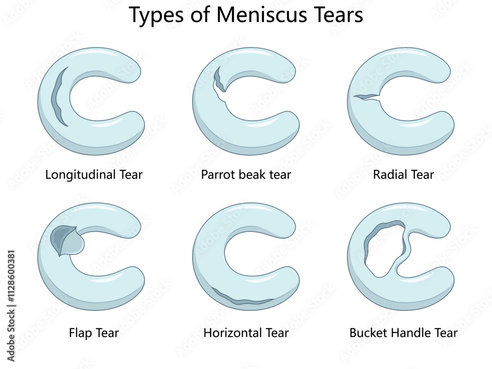 meniscus tears, including longitudinal, radial, parrot beak, flap, horizontal, and bucket handle ...