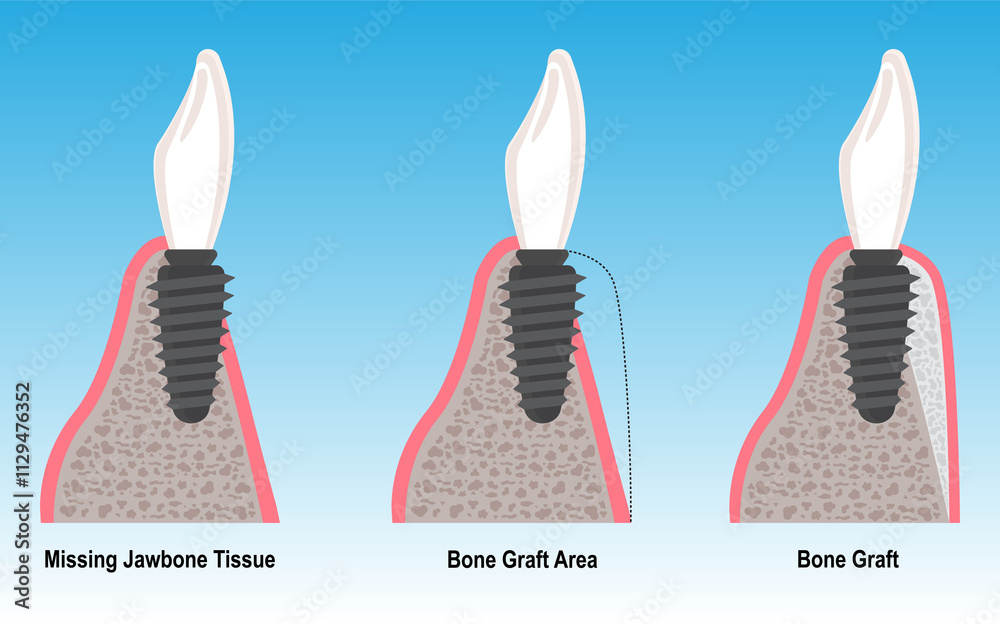 Photo Stock Bone grafting treatment for bone tissue loss and resorption ...
