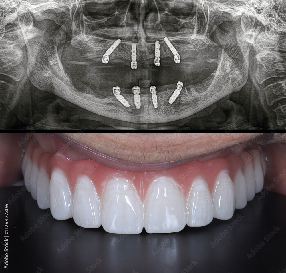 Full arch dental prosthesis supported by implants for an edentulous jaw ...