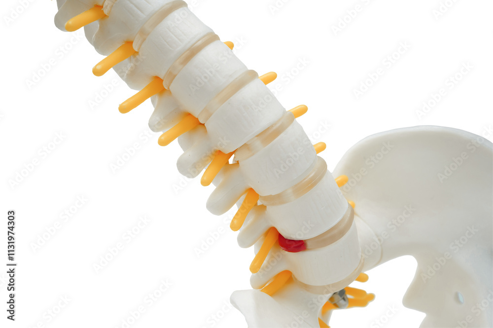 Spinal nerve and bone, Lumbar spine displaced herniated disc fragment ...