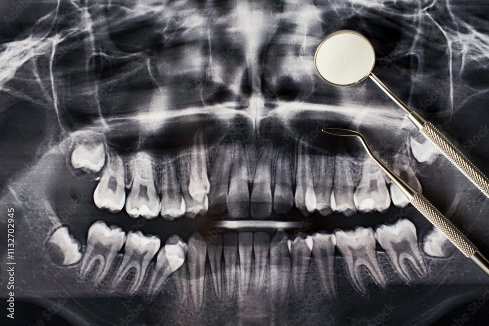 Dental x-ray and dentist tools, close-up. Panoramic x-ray radiograph of ...