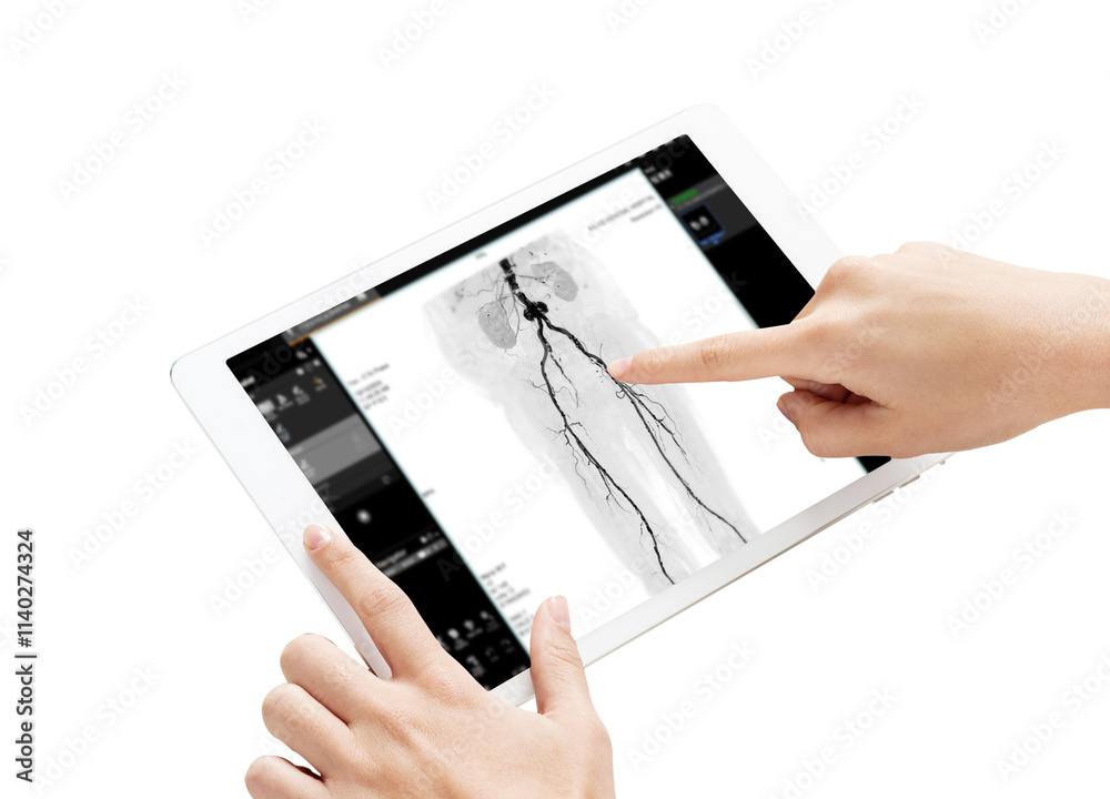 A detailed CTA scan of the femoral arteries is displayed on a digital ...