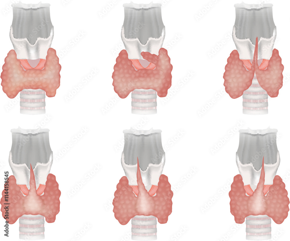 Pyramidal Lobe Variations in Thyroid Anatomy and Pyramidal Lobe. Classification of the thyroid ...