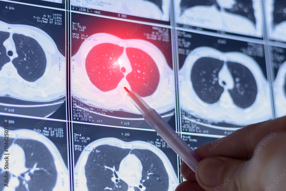 Doctor learning CT scans of lung diseases. MRI for diagnosis chest ...