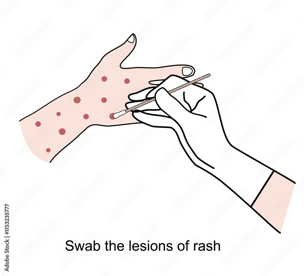 The picture shows the medical staff was swabbing the lesions of rash ...