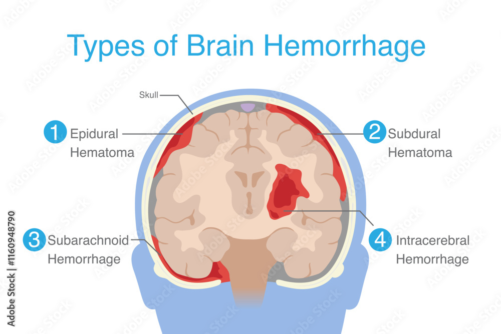 Brain hemorrhage 4 types including Epidural hemorrhage, Subdural , Subarachnoid, and ...
