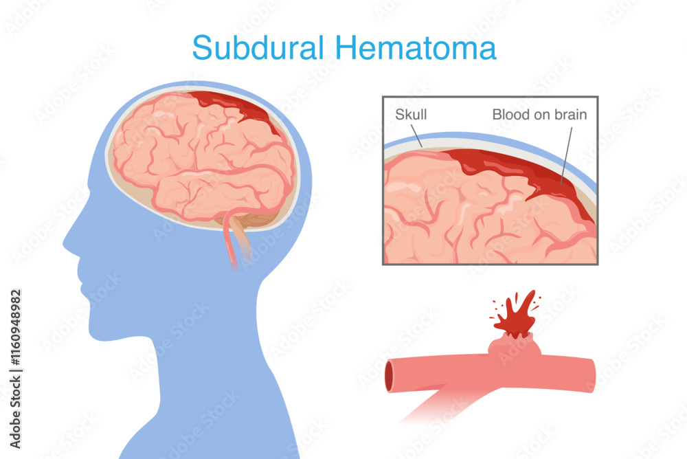 Subdural hematoma from head injury make bleeding into the brain area ...