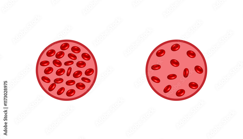 Iron deficiency anemia. The difference of Anemia amount of red blood ...