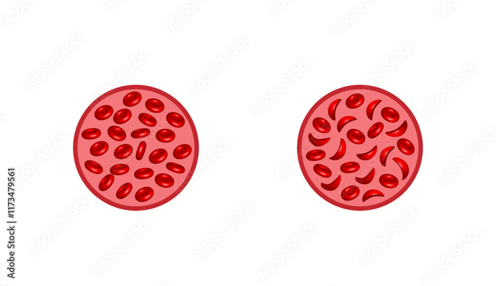 Sickle cell anemia. Normal red blood cells and sickle cells. Vector ...