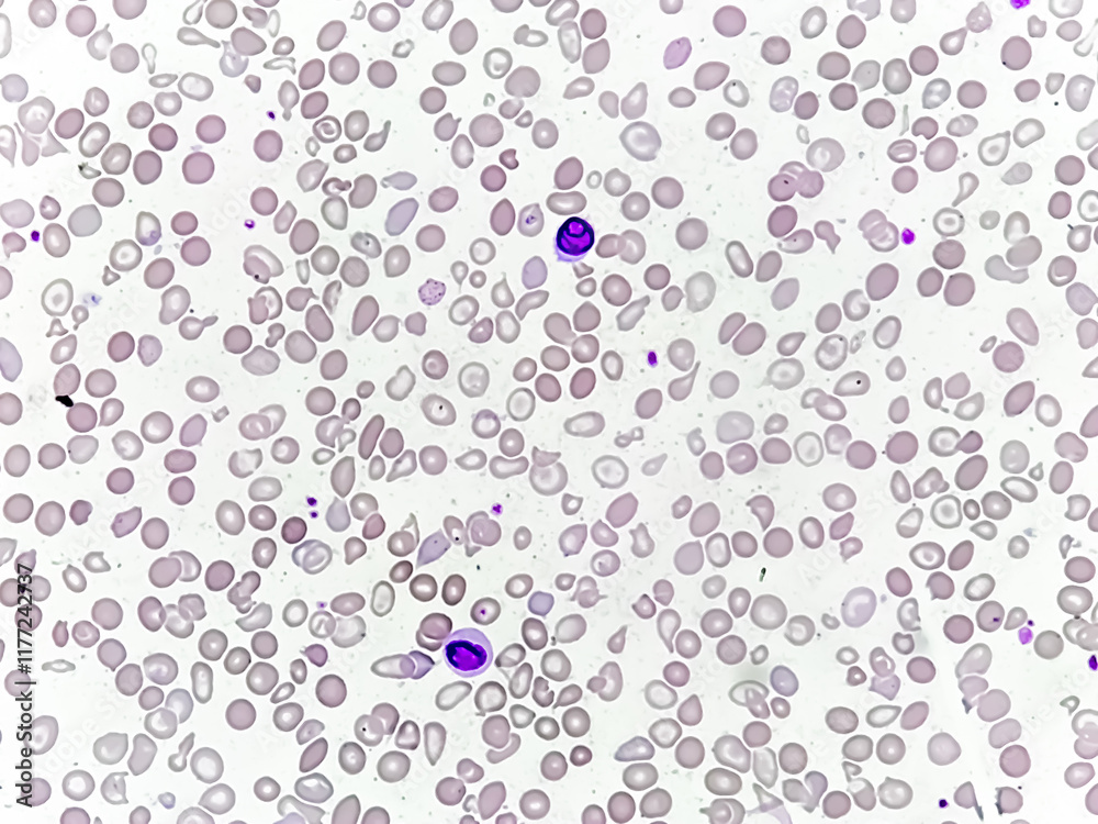 Hematological slide of Microscopic image showing severe microcytic ...
