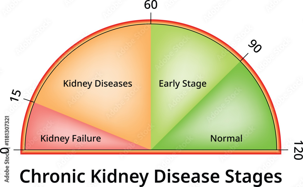Chronic Kidney Disease Stages Science Design Vector Illustration ...