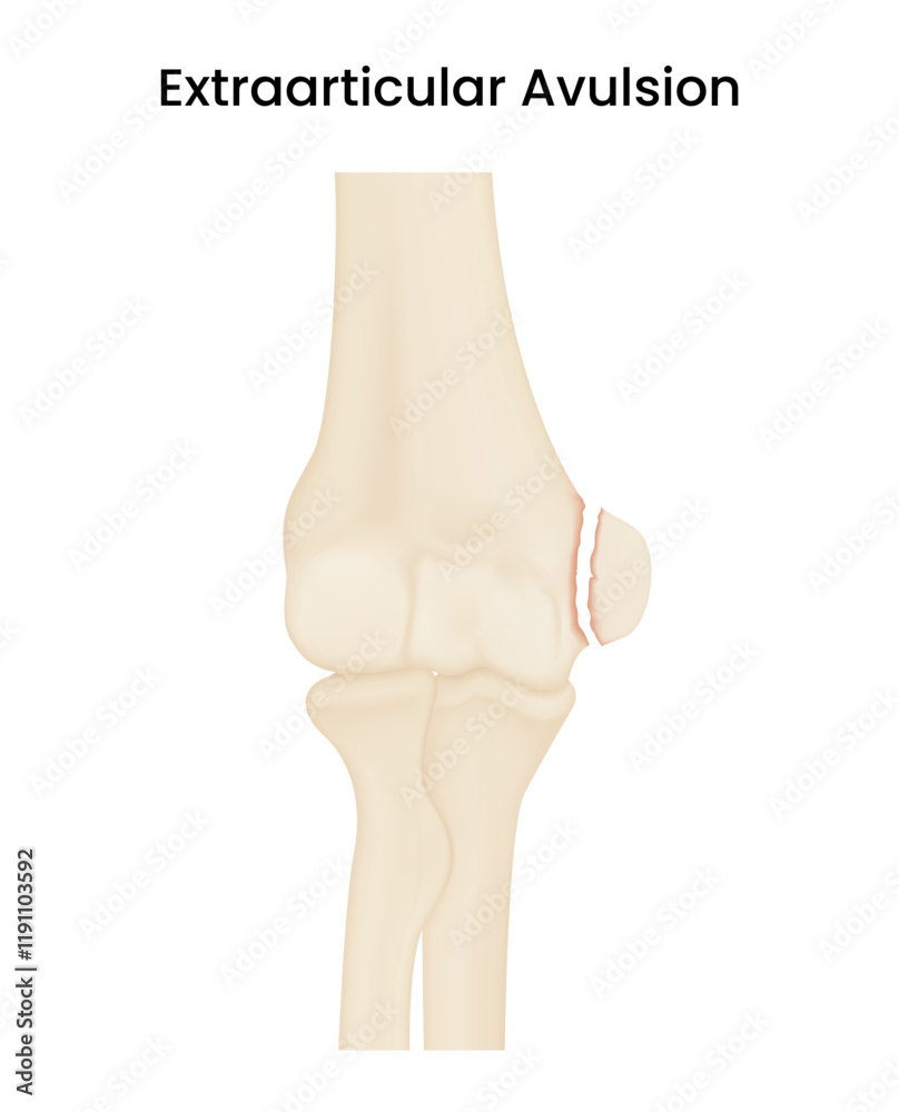 Causes of Extra Articular Avulsion Fracture Stock Vector | Adobe Stock