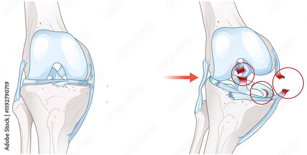 The knee's unhappy triad. Tears of the ACL, MCL, and medial meniscus ...