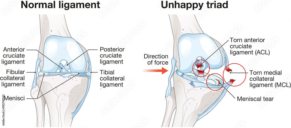 The knee's unhappy triad. Tears of the ACL, MCL, and medial meniscus ...