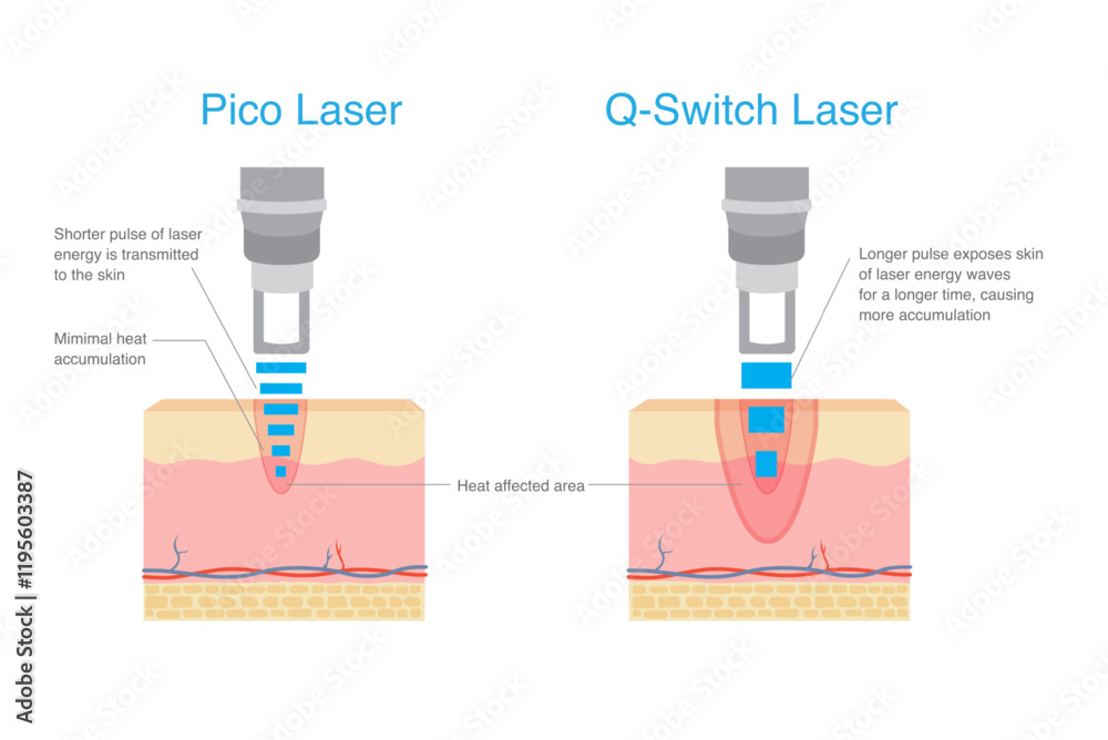Area of Pico laser pulse effected with skin layer and Q switch laser ...