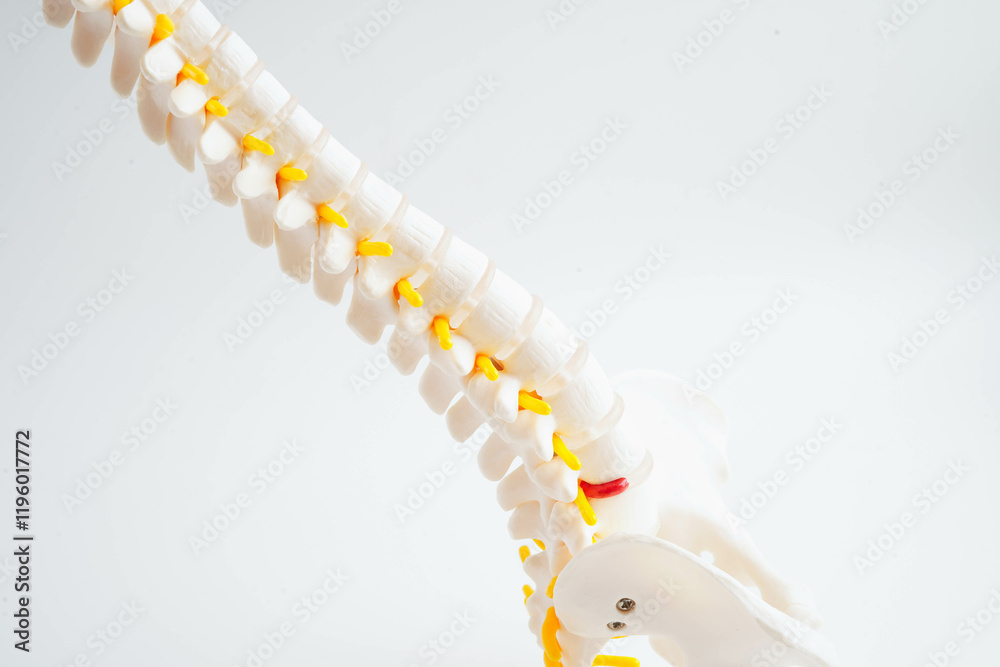 Spinal nerve and bone, Lumbar spine displaced herniated disc fragment ...