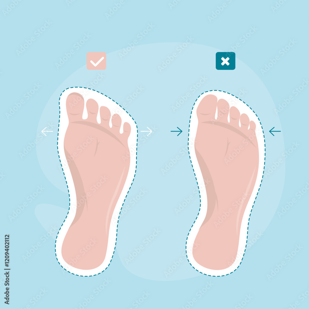 Abnormal of foot shape from deformity joint connecting big toe. Problem ...