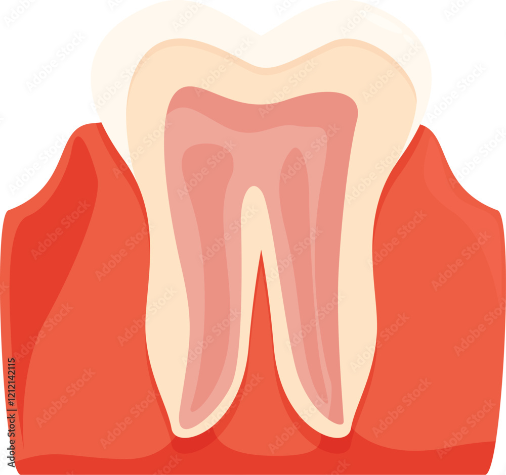 Medical illustration showing periodontitis affecting a human tooth ...