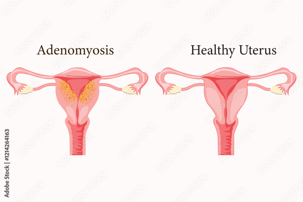 Diffuse Adenomyosis Human anatomy Female reproductive Sick system vs ...