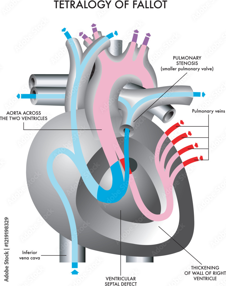 Schematic illustration of the symptoms of Tetralogy of Fallot, a congenital heart defect, with ...