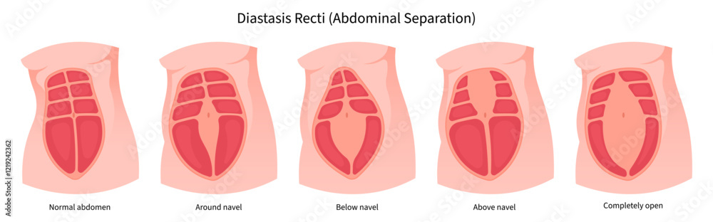 Type of abdominal muscle separation after surgical which in medical called Diastasis Recti belly ...