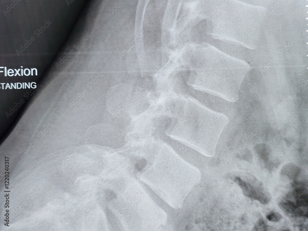 Flexion standing X-ray lumbosacral spine shows straightening of lumbar ...