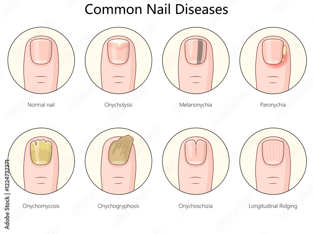 nail diseases, including onycholysis, melanonychia, paronychia ...