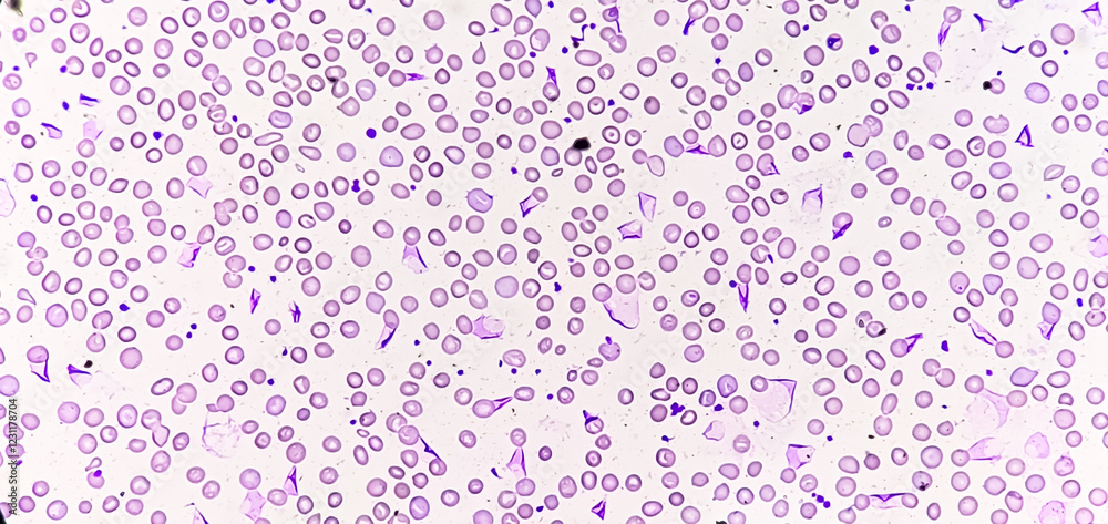 Peripheral blood smea, the red blood cells (RBCs) show anisocytosis ...