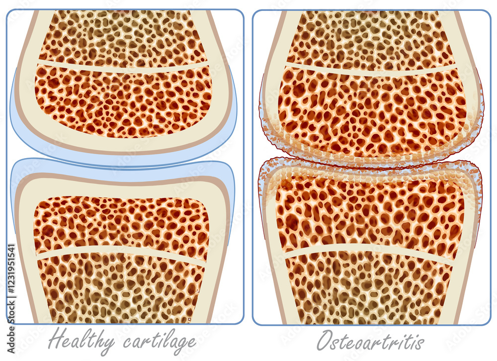 Diagram of osteoarthritis, a degenerative disease that affects the ...