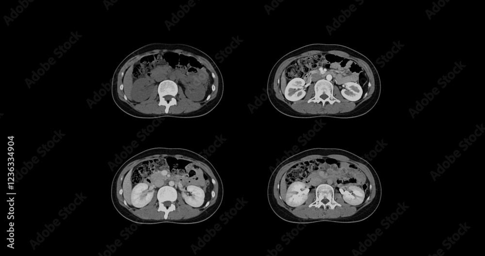 Contrast-enhanced CT whole abdomen study revealing normal anatomical ...