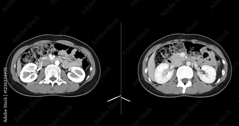 Contrast-enhanced CT whole abdomen study revealing normal anatomical ...