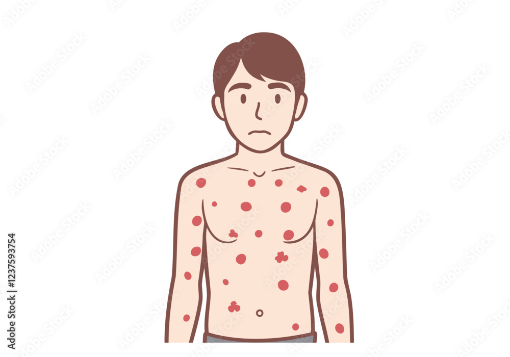 Man with Rashes: An illustration of a man's torso with visible red ...