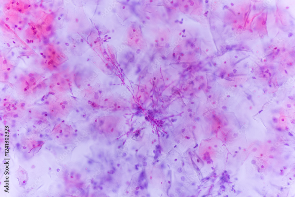 View in microscopic of Candidiasis, fungal infection (Yeast and ...
