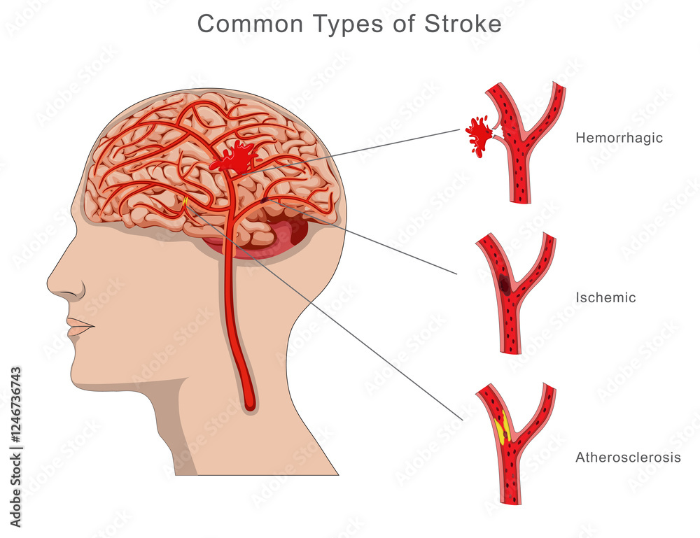 Illustration of common types of Brain stroke, including ischemic, hemorrhagic, and transient ...