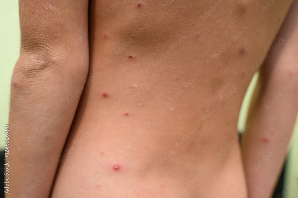 Chicken pox (varicella). Contagious disease. Sick child with chickenpox ...