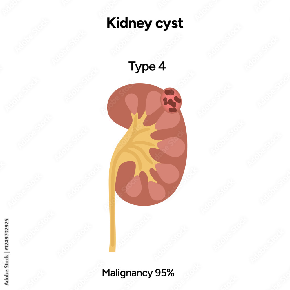 Kidney cysts urinary disease. Renal cysts of fluid in the kidneys ...
