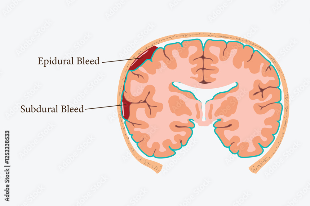 Medical illustration of epidural hematoma showing brain hemorrhage ...