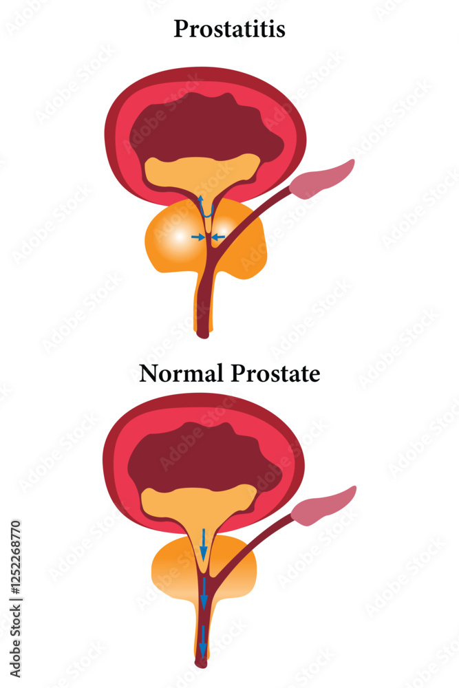 Anatomical diagram showing inflamed prostate vs. healthy prostate with ...