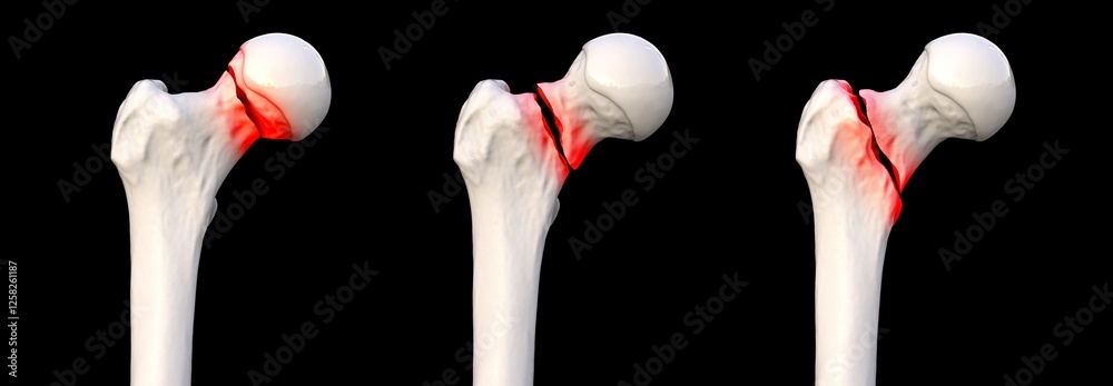Femur neck fracture types: subcapital, transcervical, and basicervical ...