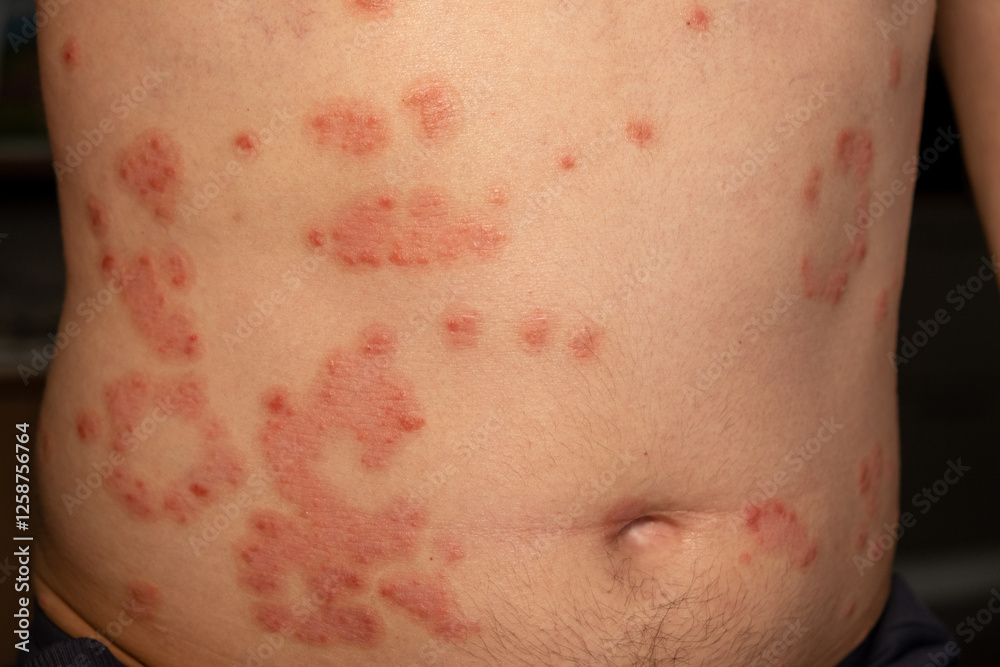 Understanding psoriasis through visible skin patches that are red ...