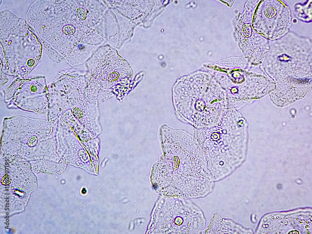 Epithelial cells with bacteria in patient urine (urinary tract ...