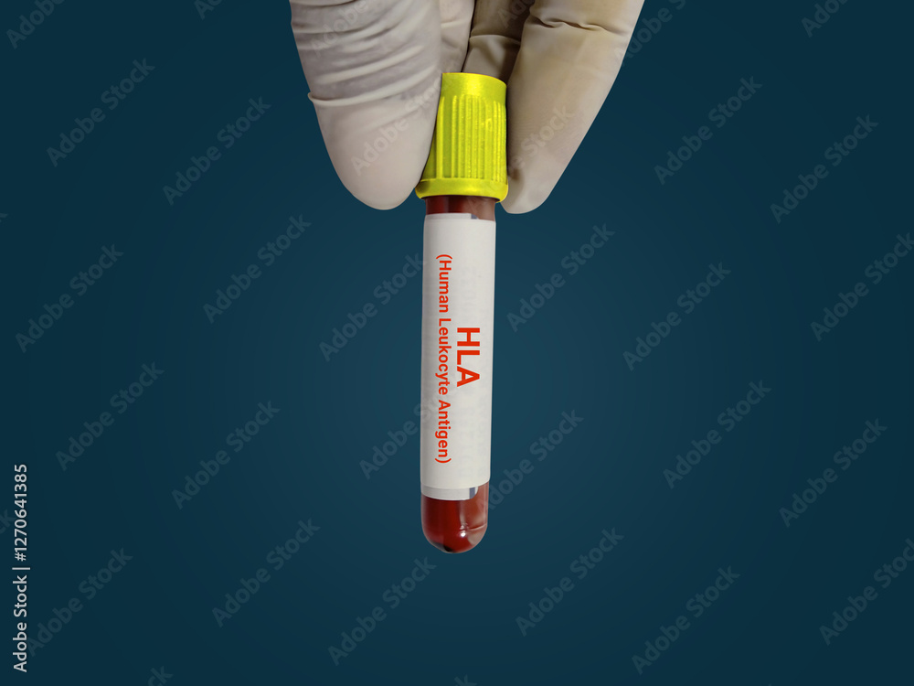 Scientist hold blood sample test tube for HLA (Human Leukocyte Antigen ...