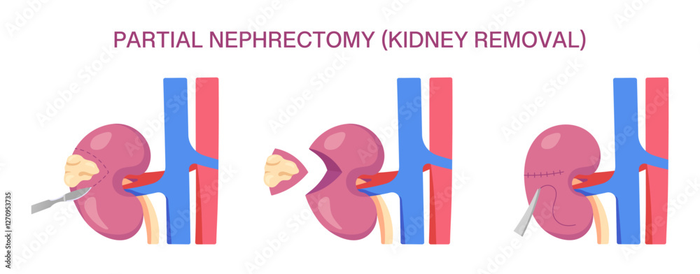 Partial Nephrectomy Surgery. Partial Nephrectomy Kidney Removal. Cross ...